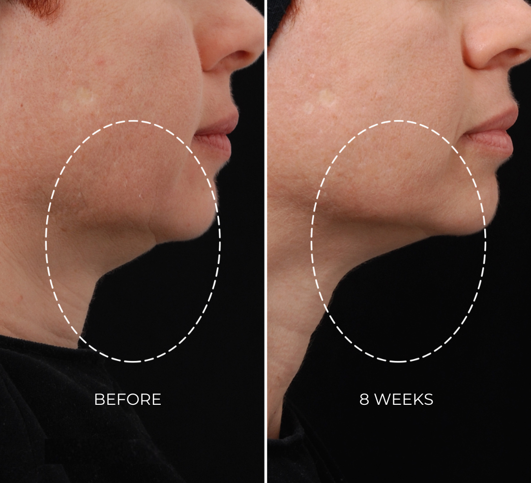 NEWA: Clinically Proven Skin Tightening with RF Technology NEWA: Clinically Proven Skin Tightening with RF Technology
