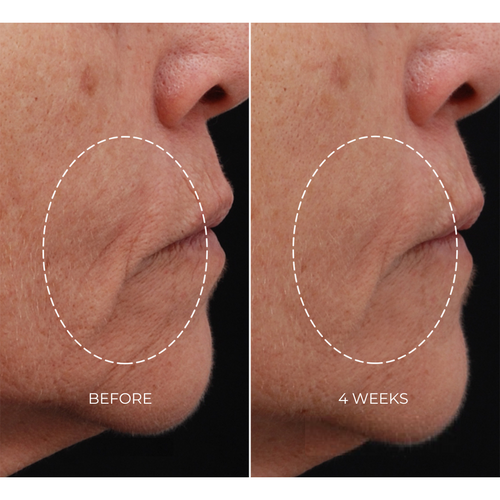 RF Skin Tightening & Wrinkle Reduction Device | NEWA+