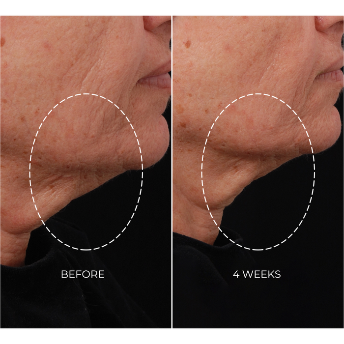 RF Skin Tightening & Wrinkle Reduction Device | NEWA+